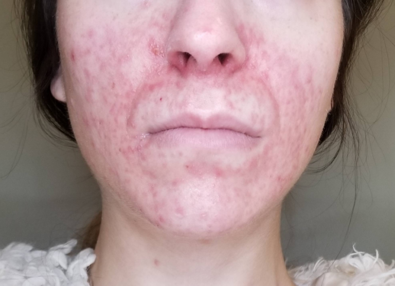 Redness around Nose Causes and How to Get Rid of Red, Dry Skin on Nose ...