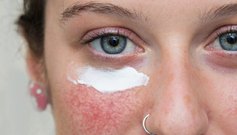 Redness around Nose Causes and How to Get Rid of Red, Dry Skin on Nose ...