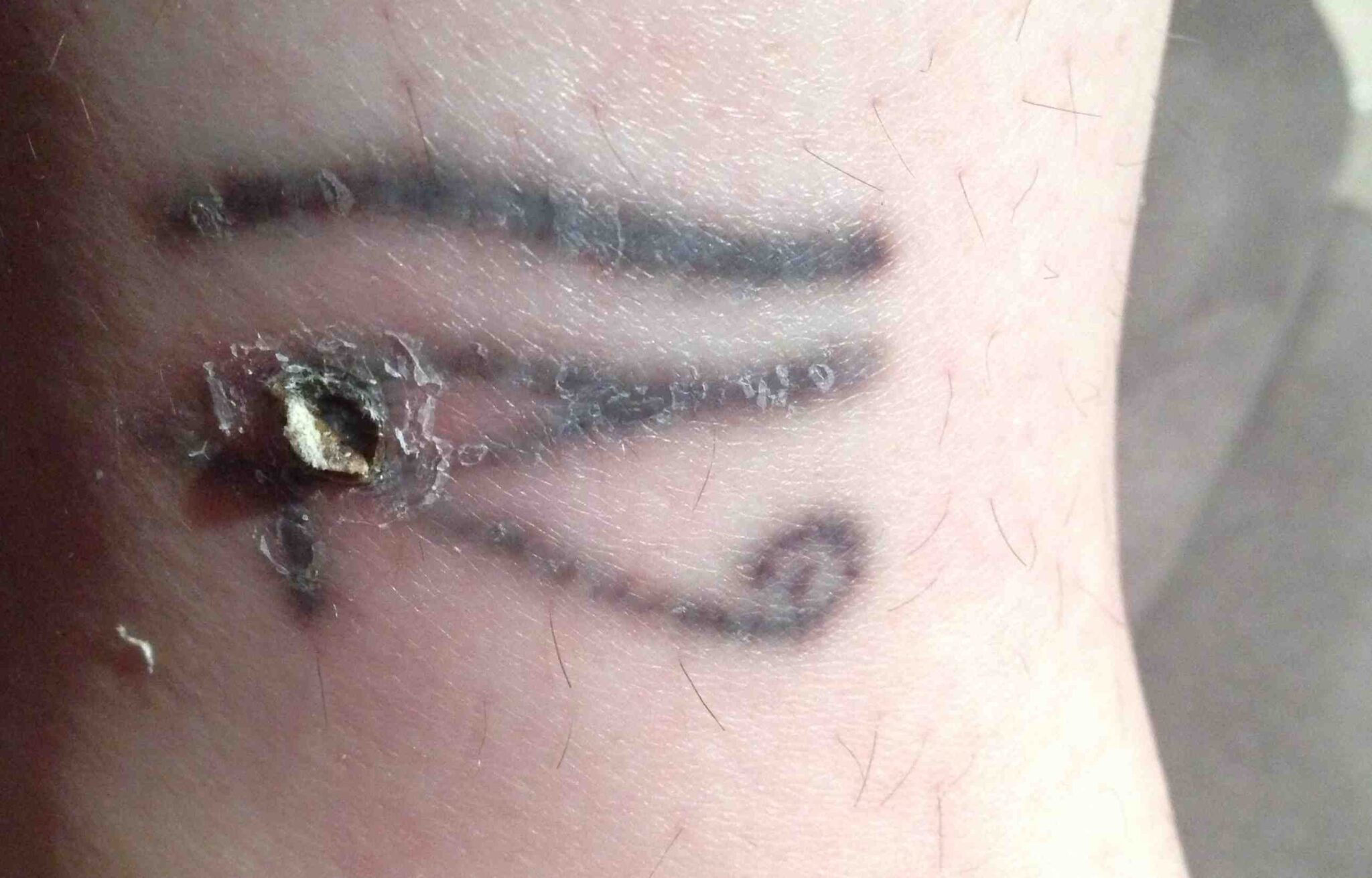 Why Tattoo Peeling, Peeling Process, Ink, and Peeling Tattoo Care ...