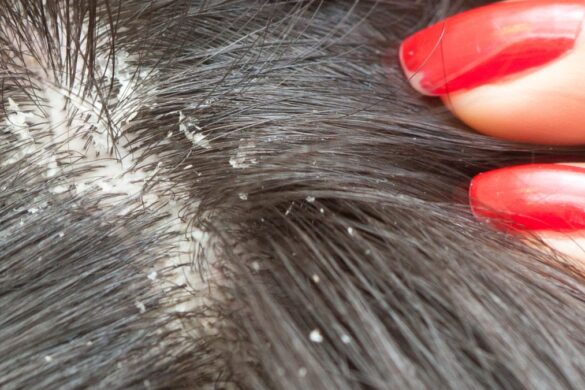 Smelly Scalp Causes, Symptoms, Treatments, Home Remedies for Scalp Odor ...