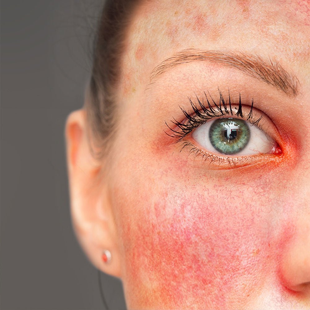 How to Manage Topical Steroid Withdrawal? - American Celiac