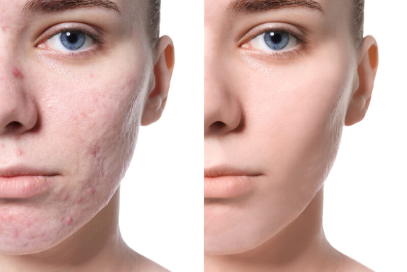 Say Goodbye to Acne: Revolutionary Acne Treatment Guaranteed to Clear ...