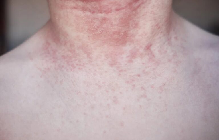 Effect of Gluten on Skin: Understanding Reactions and Implications ...